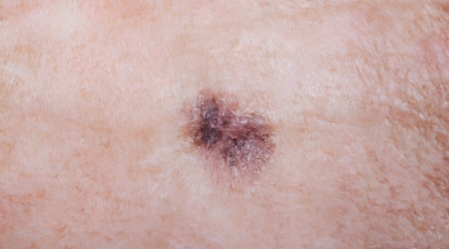 Understanding Skin Cancer Types and the Importance of Early Detection ...
